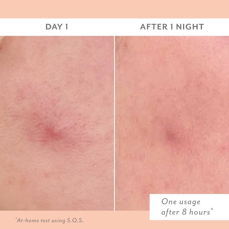 S.O.S. | 24/7 Clarity, Zero Visibility | Acne Liquid Pimple Patch ...